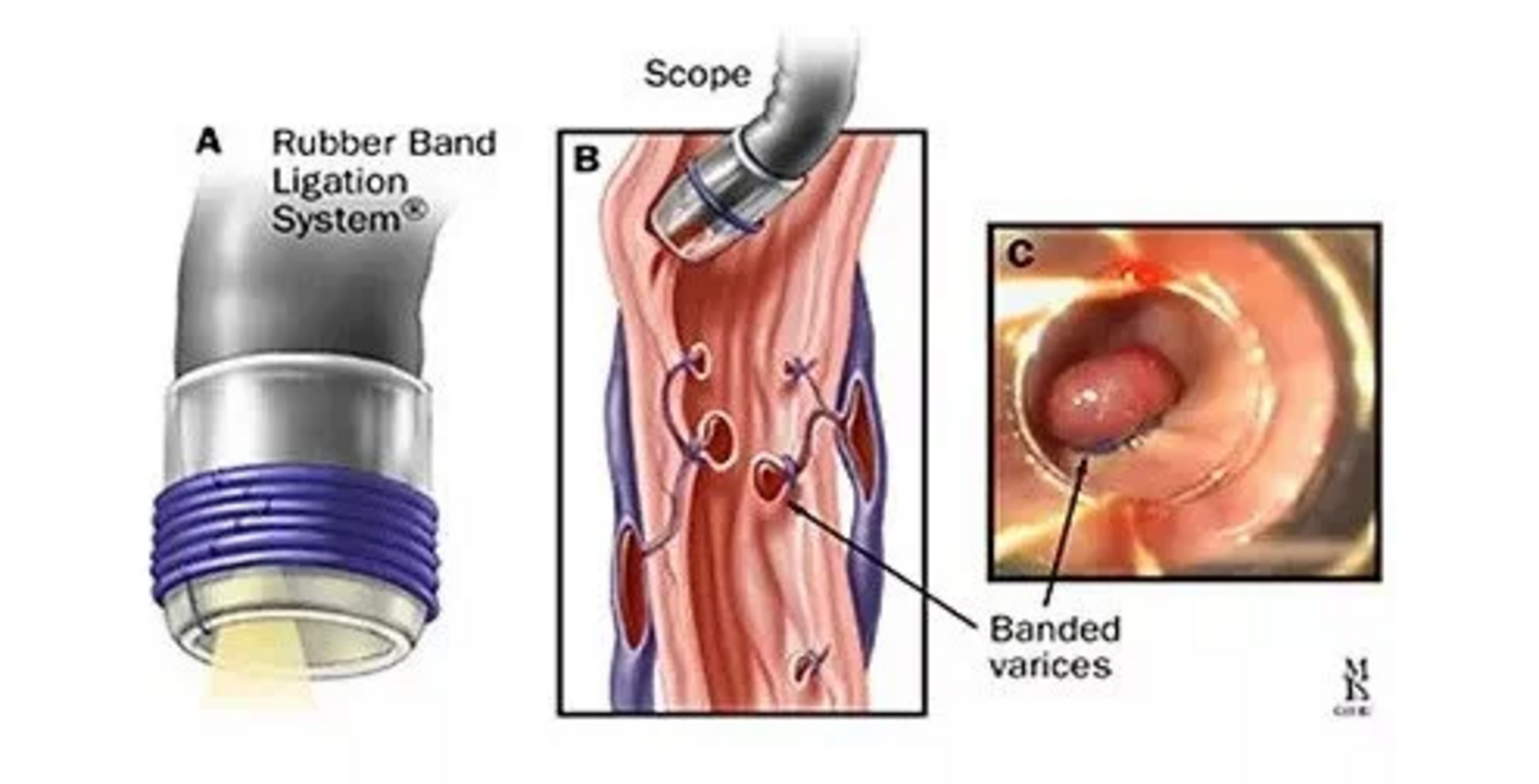 Endoscopic Variceal Ligation (EVL) at RL Gastrocare | Dr. Rupesh Lunkad | RL GASTRO CARE